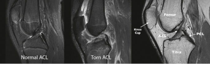 ACL Cross Bracing Protocol - Robina Physiotherapy Clinic Gold Coast QLD